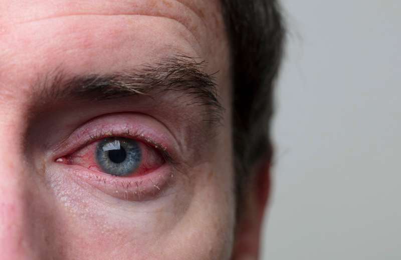 Scratchy, Sore Eyes? It may be Blepharitis. - Cascadia Eye