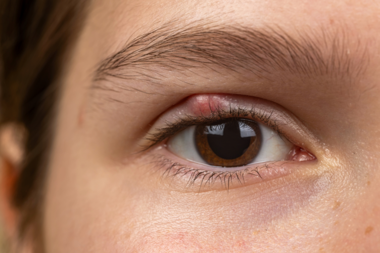 What is the difference between a Stye and a Chalazion?