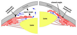 Understanding Open and Closed Angle Glaucoma - Cascadia Eye